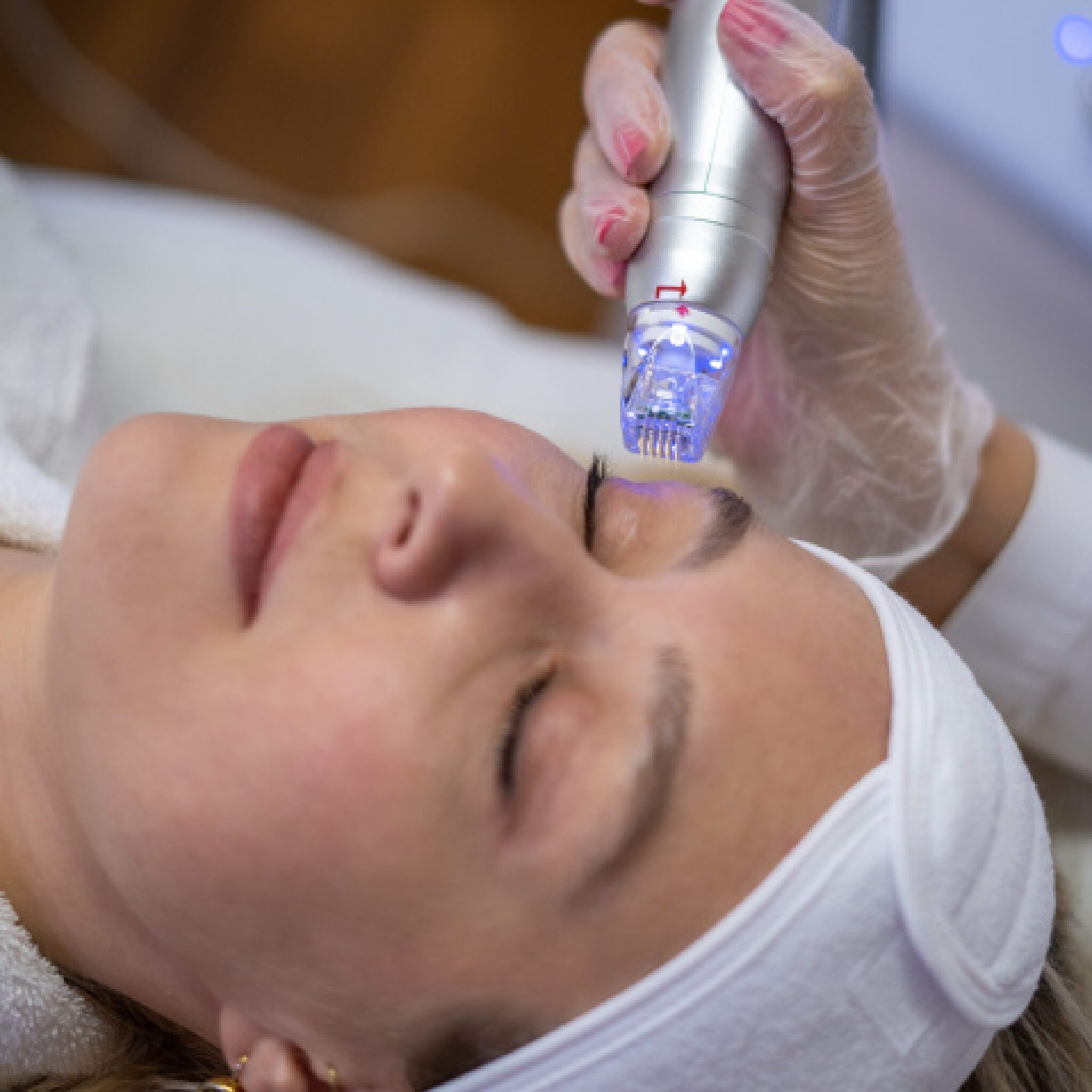 SCARLET RF: RADIOFRECUENCIA + MICRONEEDLING - LeDerme