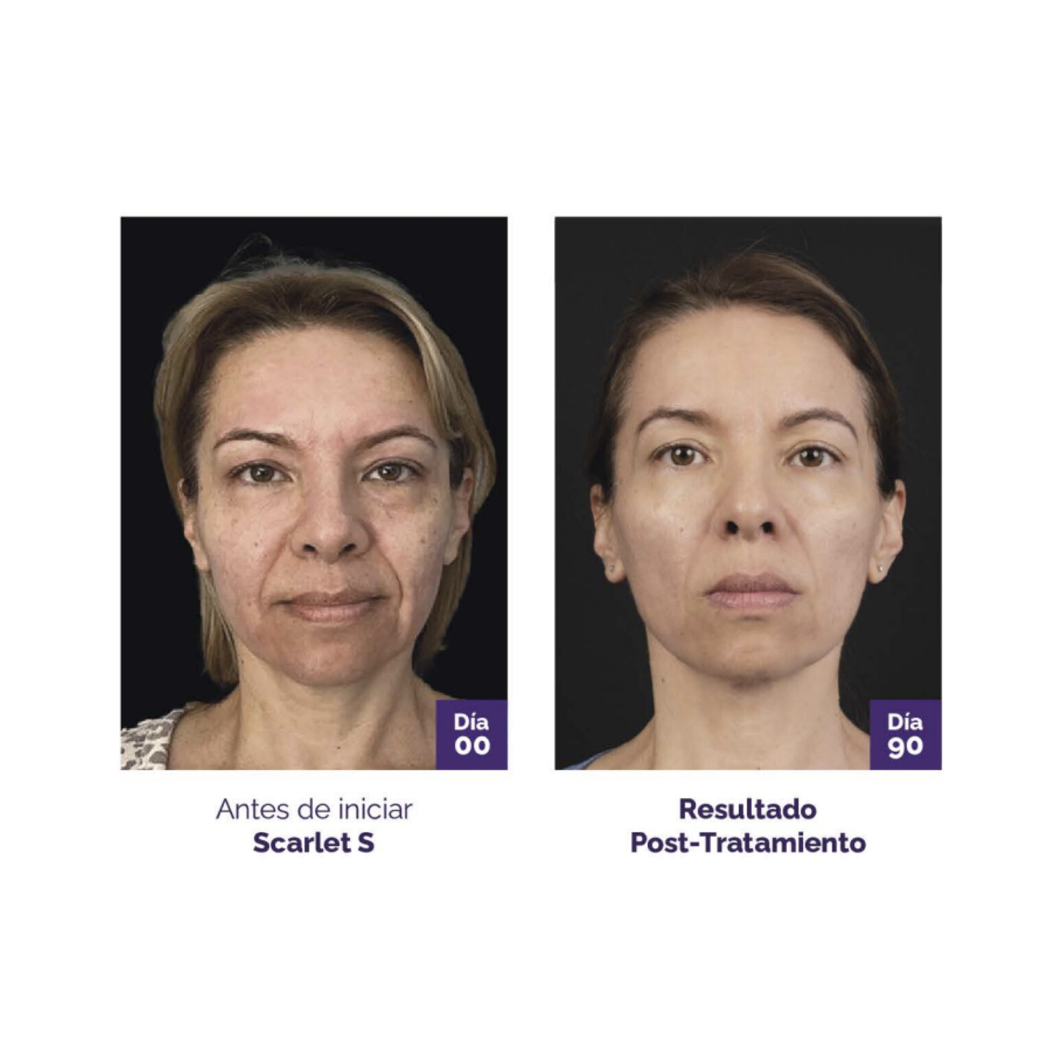 SCARLET RF: RADIOFRECUENCIA + MICRONEEDLING - LeDerme